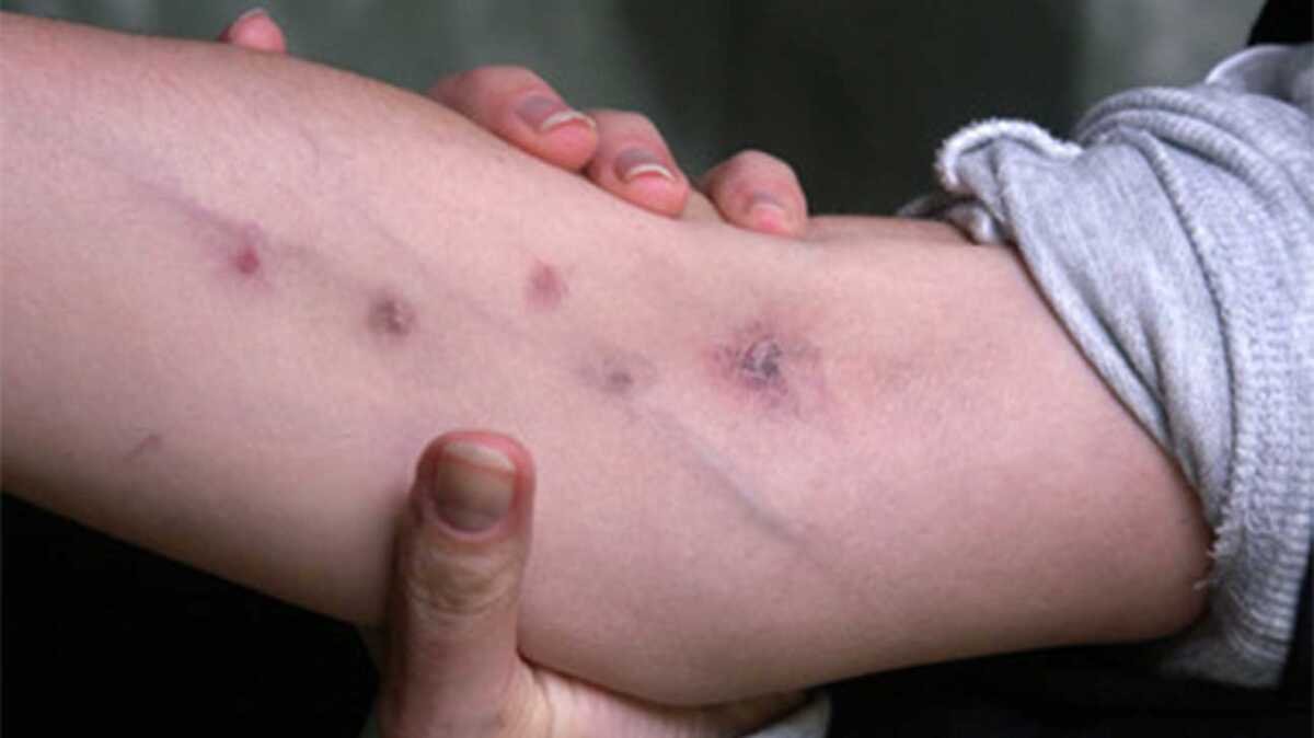 Reconnaître les yeux d'une personne droguée : les signes